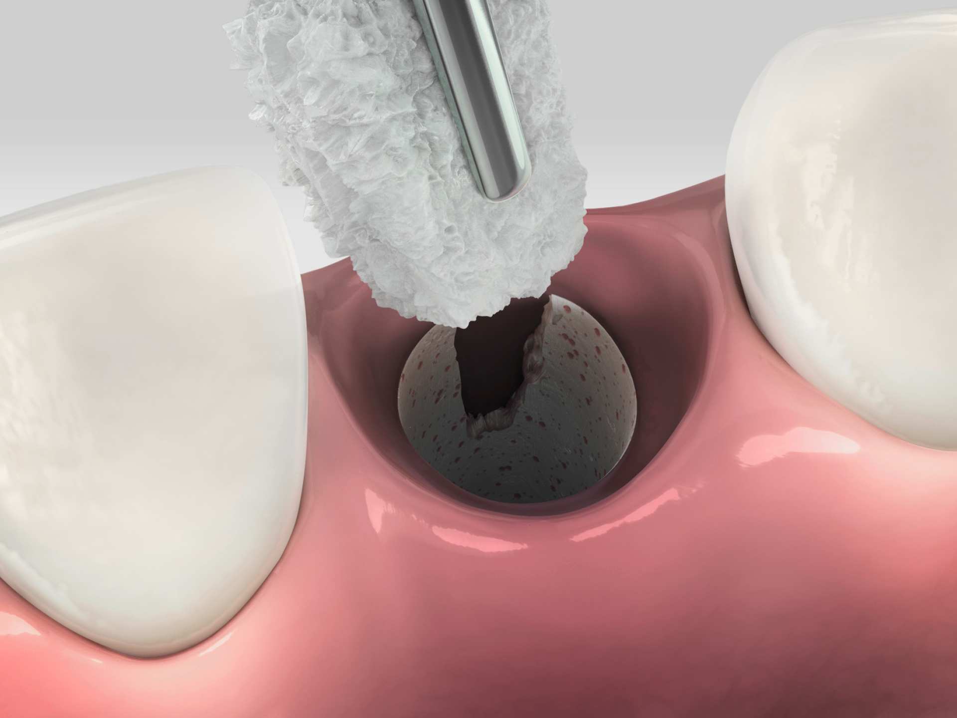 Ridge Preservation after Tooth Extraction