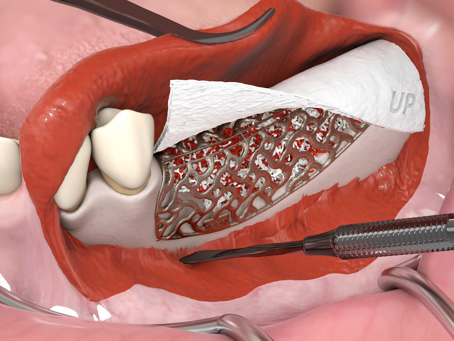 Major Bone Augmentation